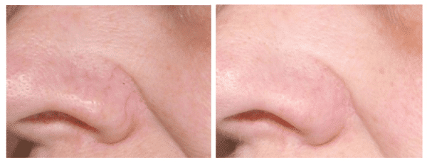 La thermocoagulation du vasculyse (nouveau service) - Escale Beauté